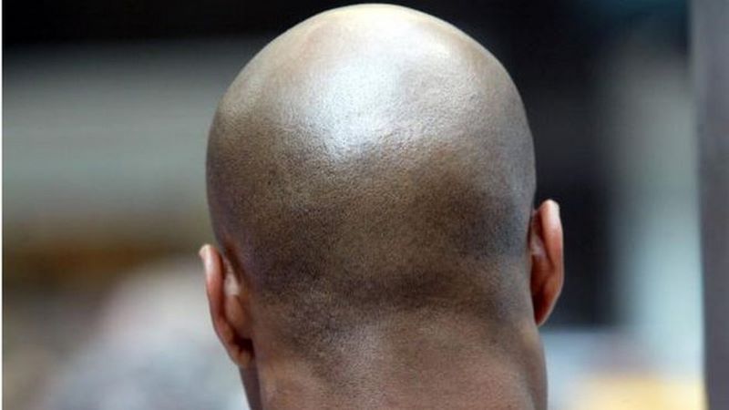 Men: How to spot the early warning signs of baldness - Adomonline.com