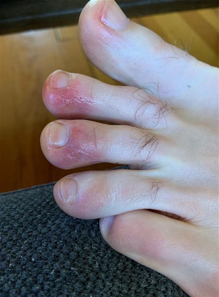 Experts reveal strange symptom of coronavirus: Colour of your toes ... Experts reveal strange symptom of coronavirus: Colour of your toes ...