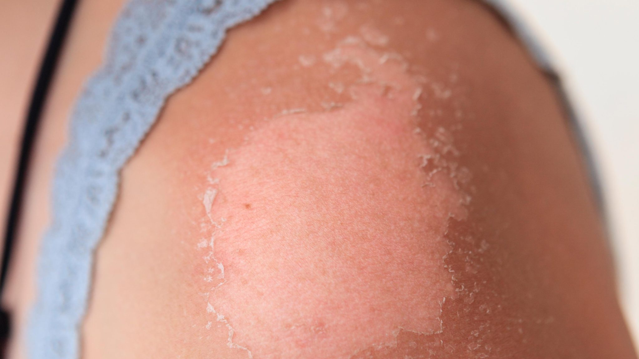 Here Are The Possible Causes And Home Remedies For Peeling Skin