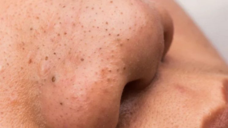 4 simple remedies to get rid of pimples on the nose - Adomonline.com