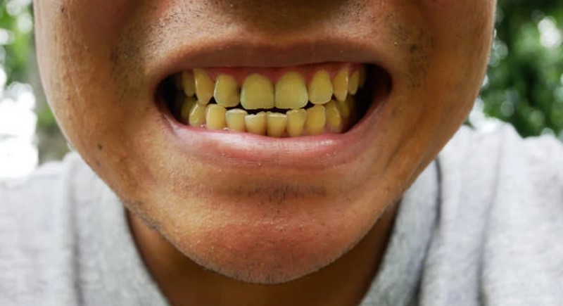 5 effective ways to get rid of yellow teeth - Adomonline.com