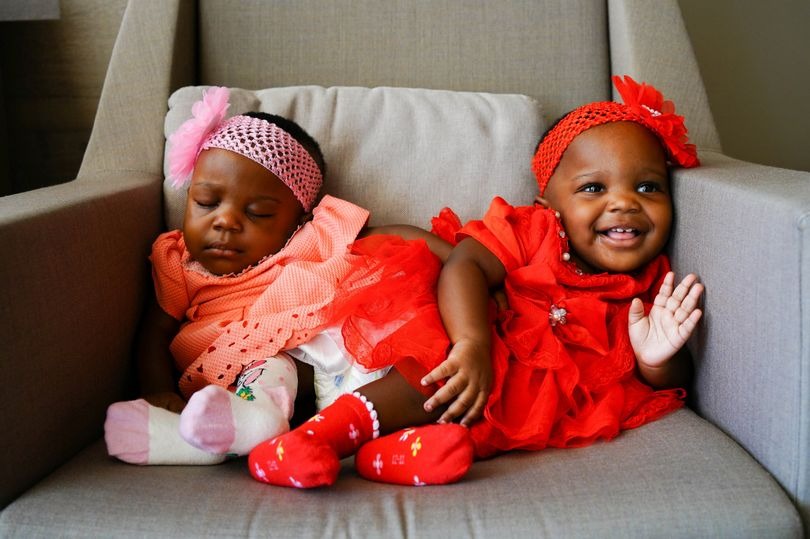 Conjoined twins survive 27-hour intense surgery - Adomonline.com