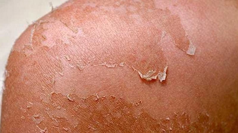 Five things to do if your skin is peeling - Adomonline.com