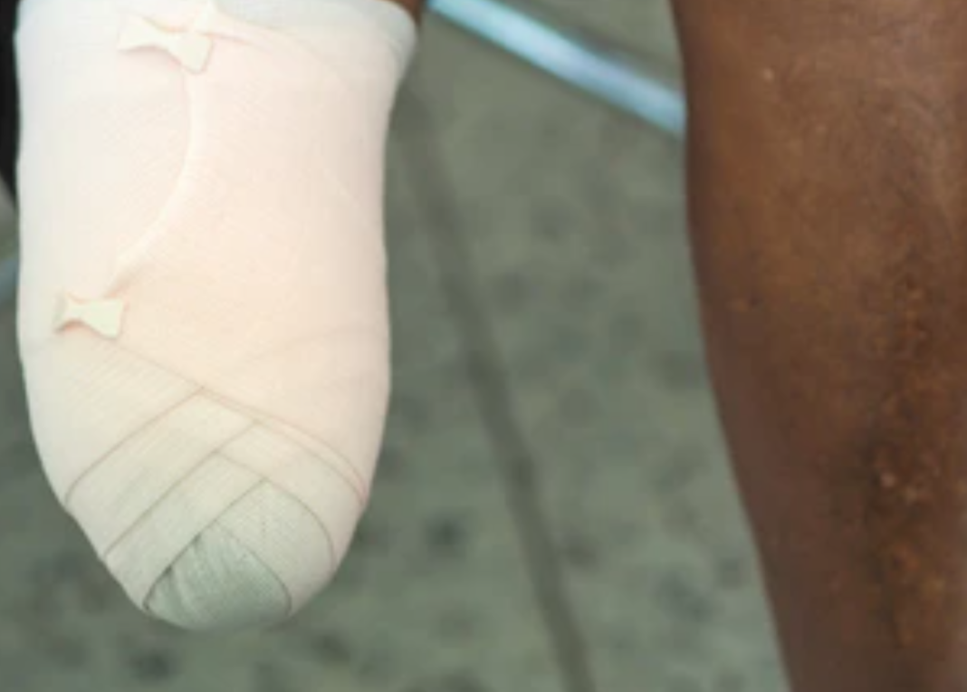 Doctor fined for amputating wrong leg of patient - Adomonline.com