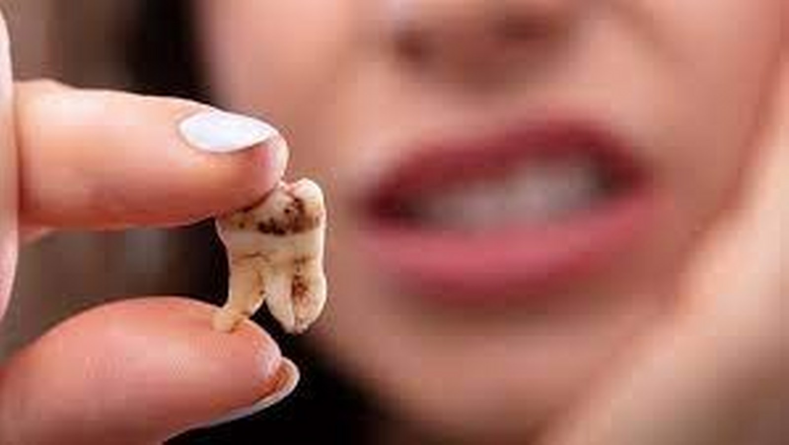 Three home remedies for tooth decay and cavities - Adomonline.com