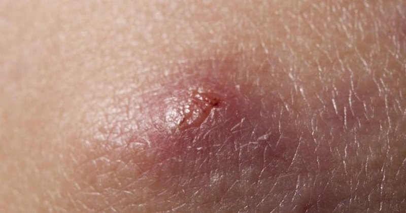 This is why you keep having boils repeatedly - Adomonline.com