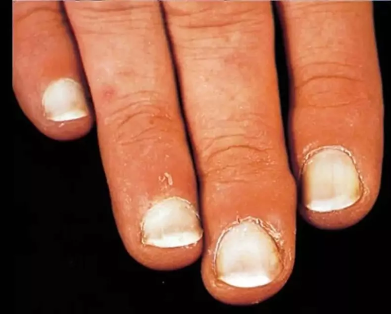Here's what your fingernails reveal about the state of your health ...