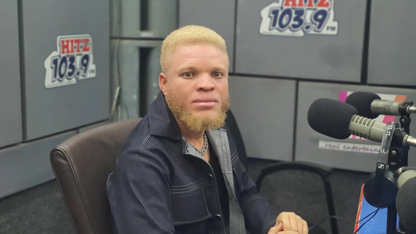 I was rejected by record labels due to my albinism, poor eyesight ...